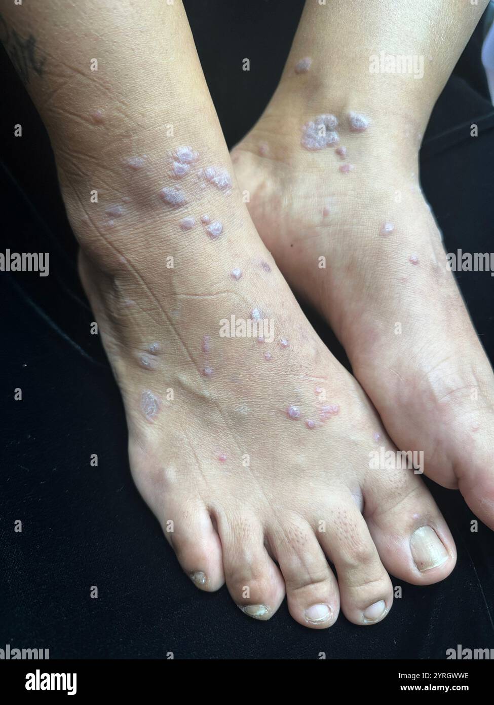 Lichen planus on a Hispanic female patient's ankles and feet. Lichen ...