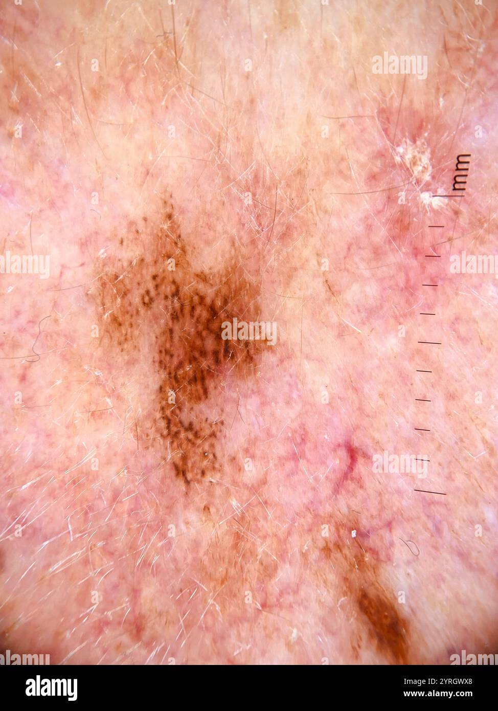 Lentigo maligna melanoma, dermoscopy Stock Photo - Alamy