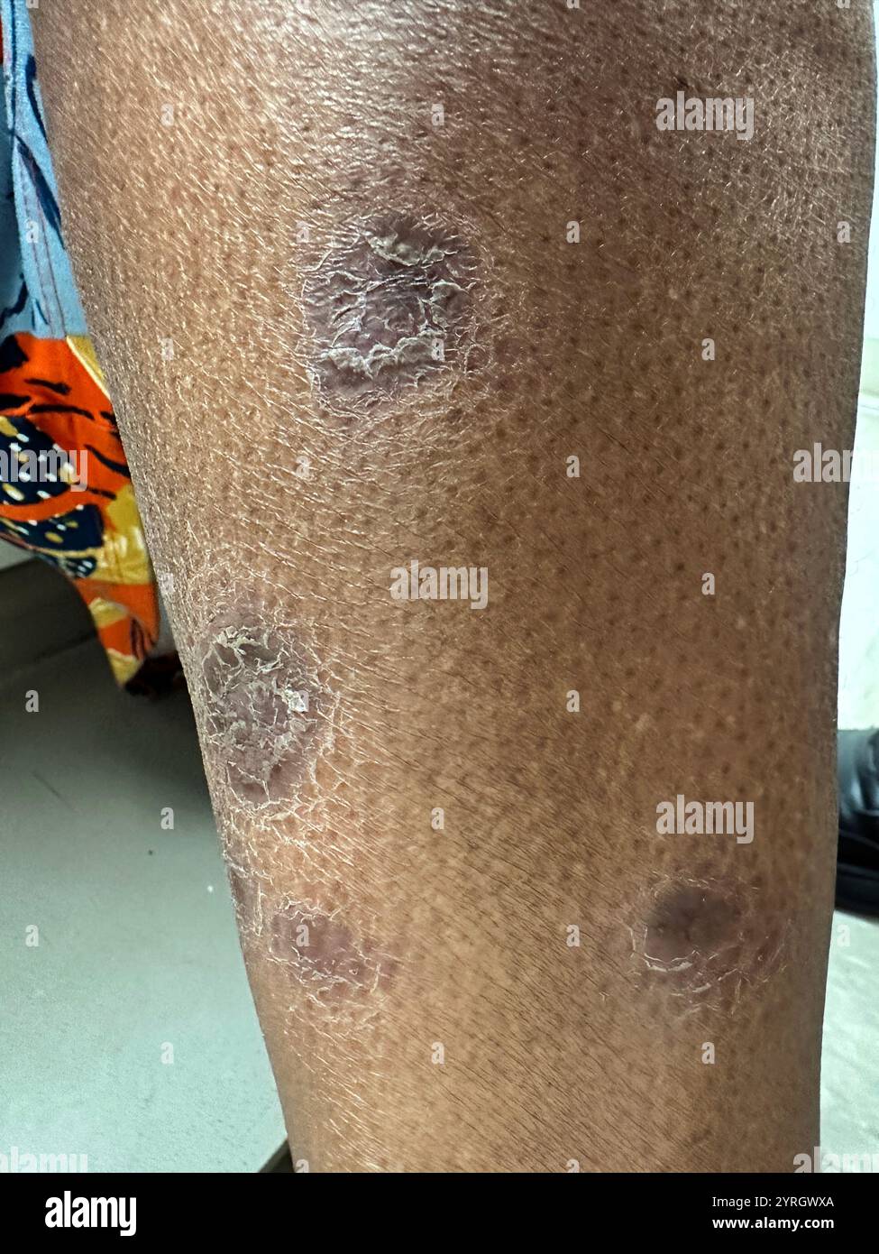 Lesions on the leg of an African-American woman with sarcoidosis. Also ...