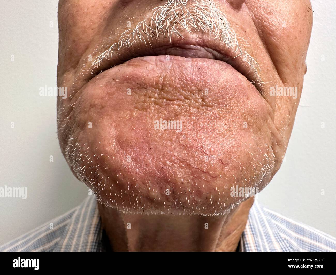 Ringworm infection on a male patient's chin that has been successfully ...