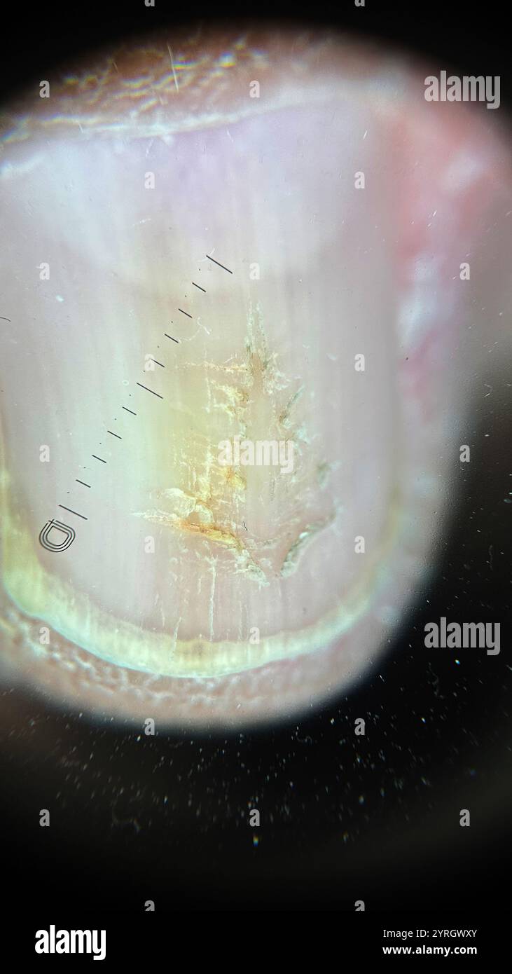 Dermatoscope image of median nail dystrophy on a patient's thumbnail ...