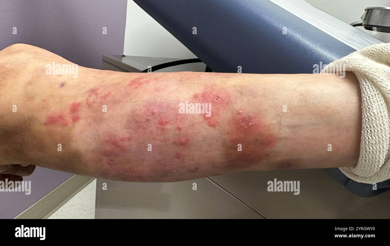 Contact dermatitis and pressure urticaria in a patient that has been ...