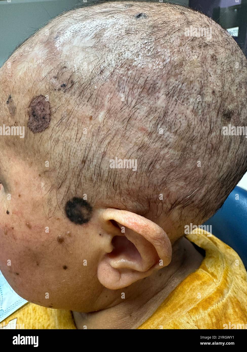 Multiple basal cell carcinomas (BCCs), or rodent ulcers, on a patient's ...