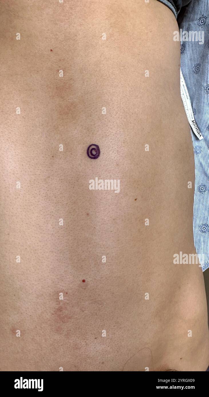 Lesion on a patient's skin marked for a punch biopsy. A circular area ...