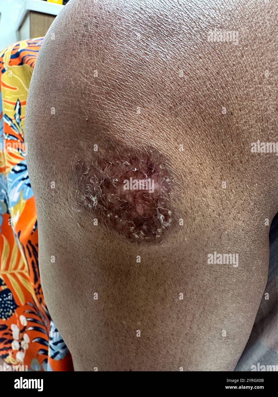 Lesion on the leg of an African-American woman with sarcoidosis. Also ...