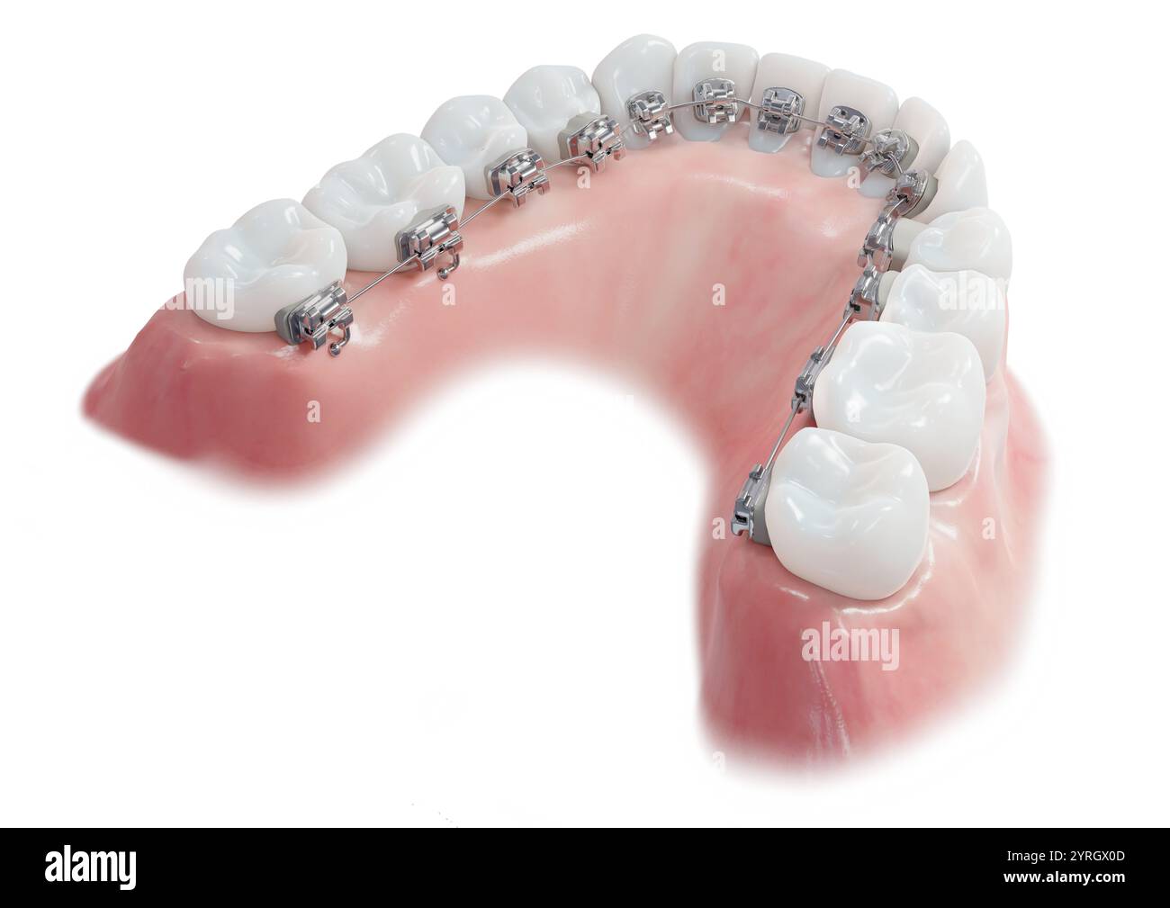 Illustration of an orthodontic model with dental brace brackets ...