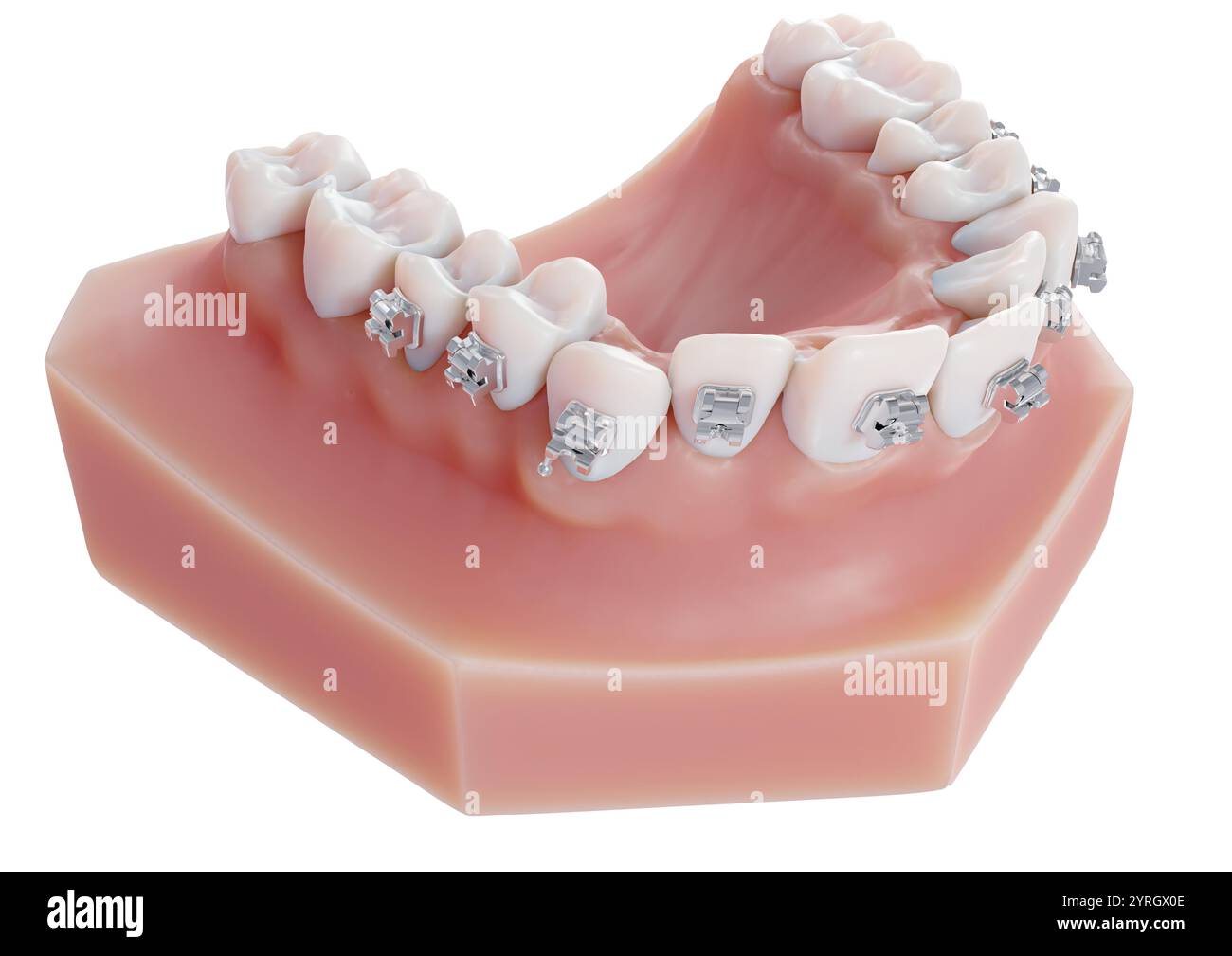 Illustration of an orthodontic model with dental brace brackets ...