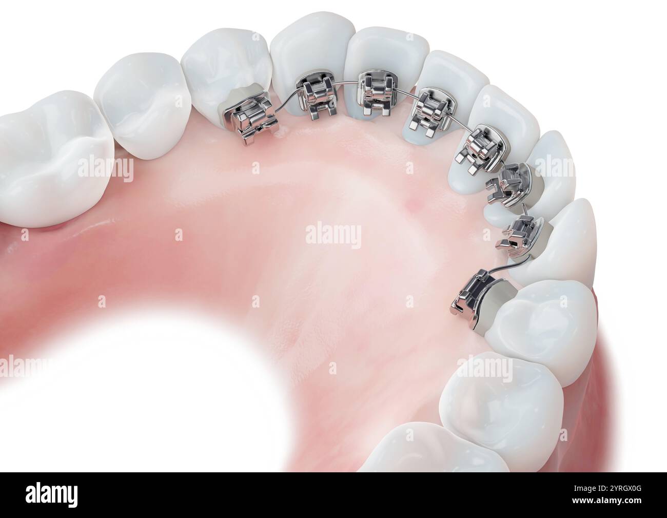 Illustration of a lower jaw with a dental brace with brackets attached ...