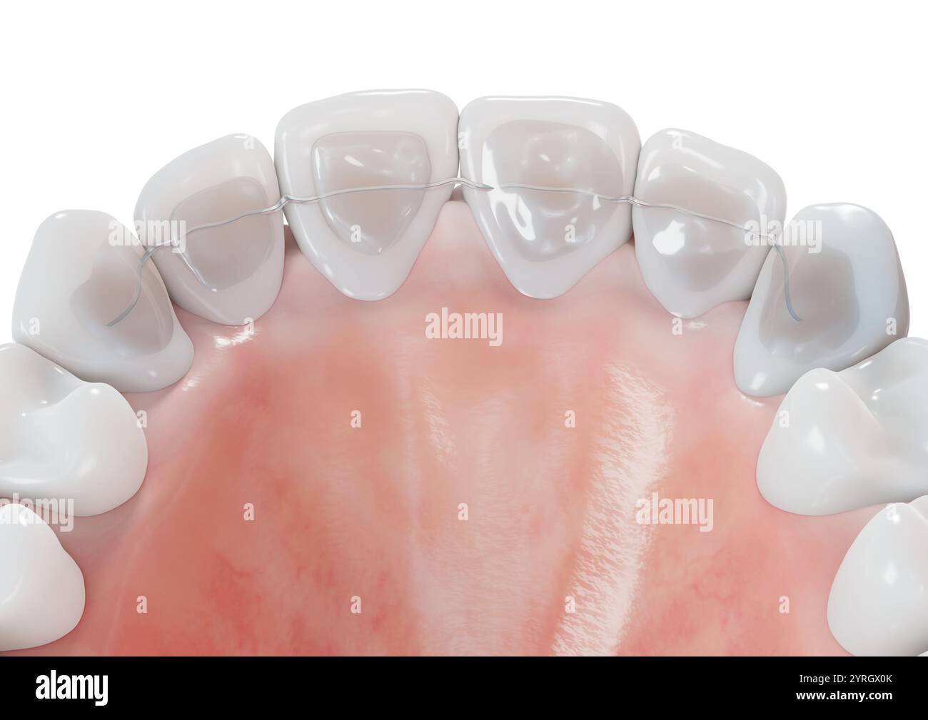 Illustration of a bonded retainer behind the teeth of the lower jaw ...