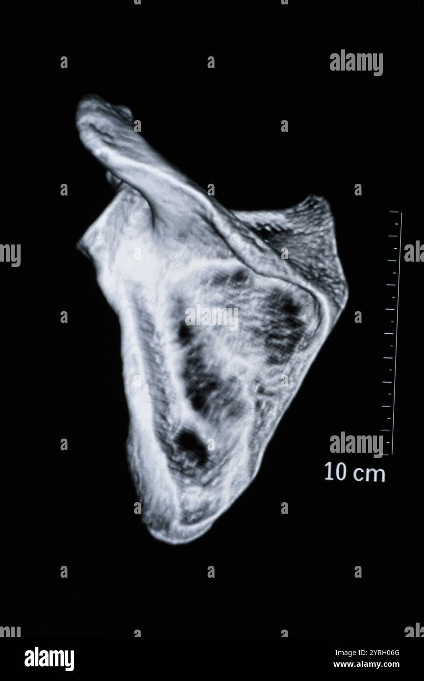 Human bone ct images hi-res stock photography and images - Alamy