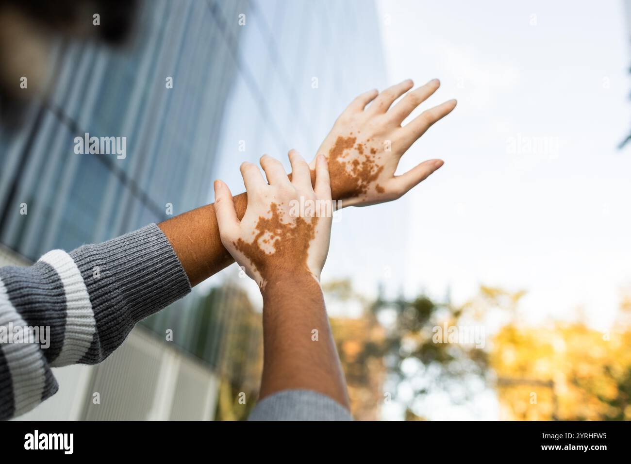 A mixed race person with vitiligo enjoys a relaxing day on a university ...
