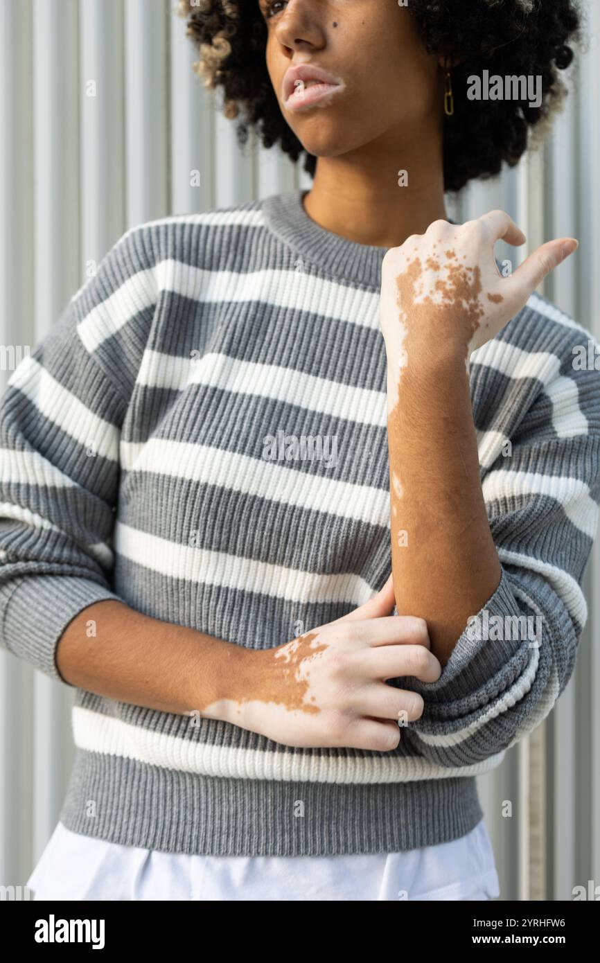A mixed race woman with vitiligo relaxes on a university campus ...