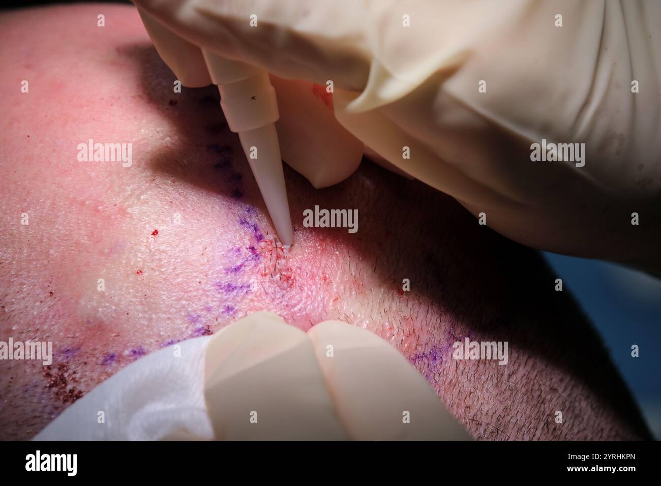 A detailed close-up image of a hair transplant procedure, showcasing a ...