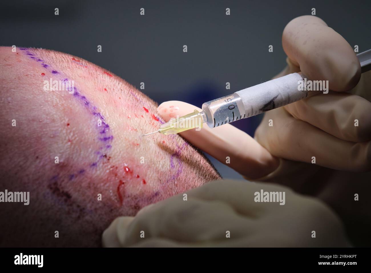 Close-up of a hair transplant procedure, focusing on the precise ...