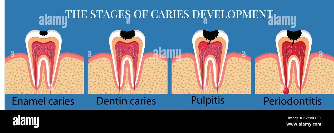 Stages of caries development with text Stock Vector Image & Art - Alamy