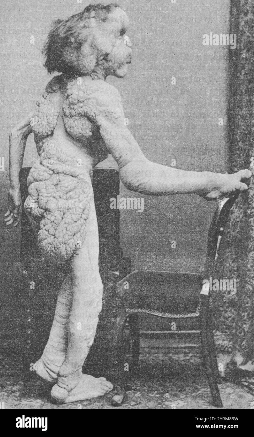 Joseph Carey Merrick (5 August 1862 ? 11 April 1890), often erroneously ...