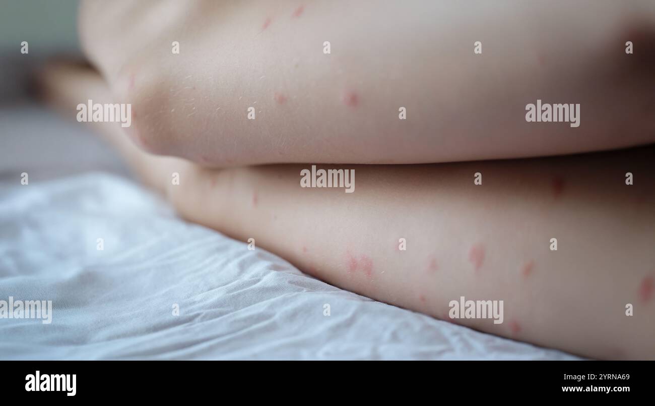 Red rash on the white skin of female legs, pimples Stock Photo - Alamy