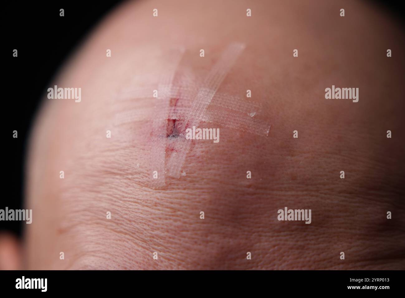 Laceration hi-res stock photography and images - Alamy