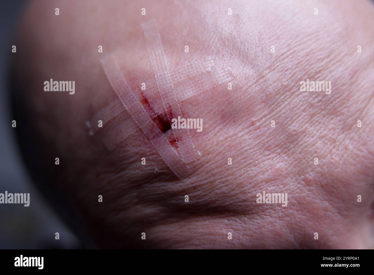 Hematoma contusion and cut on forehead icing injury Stock Photo - Alamy