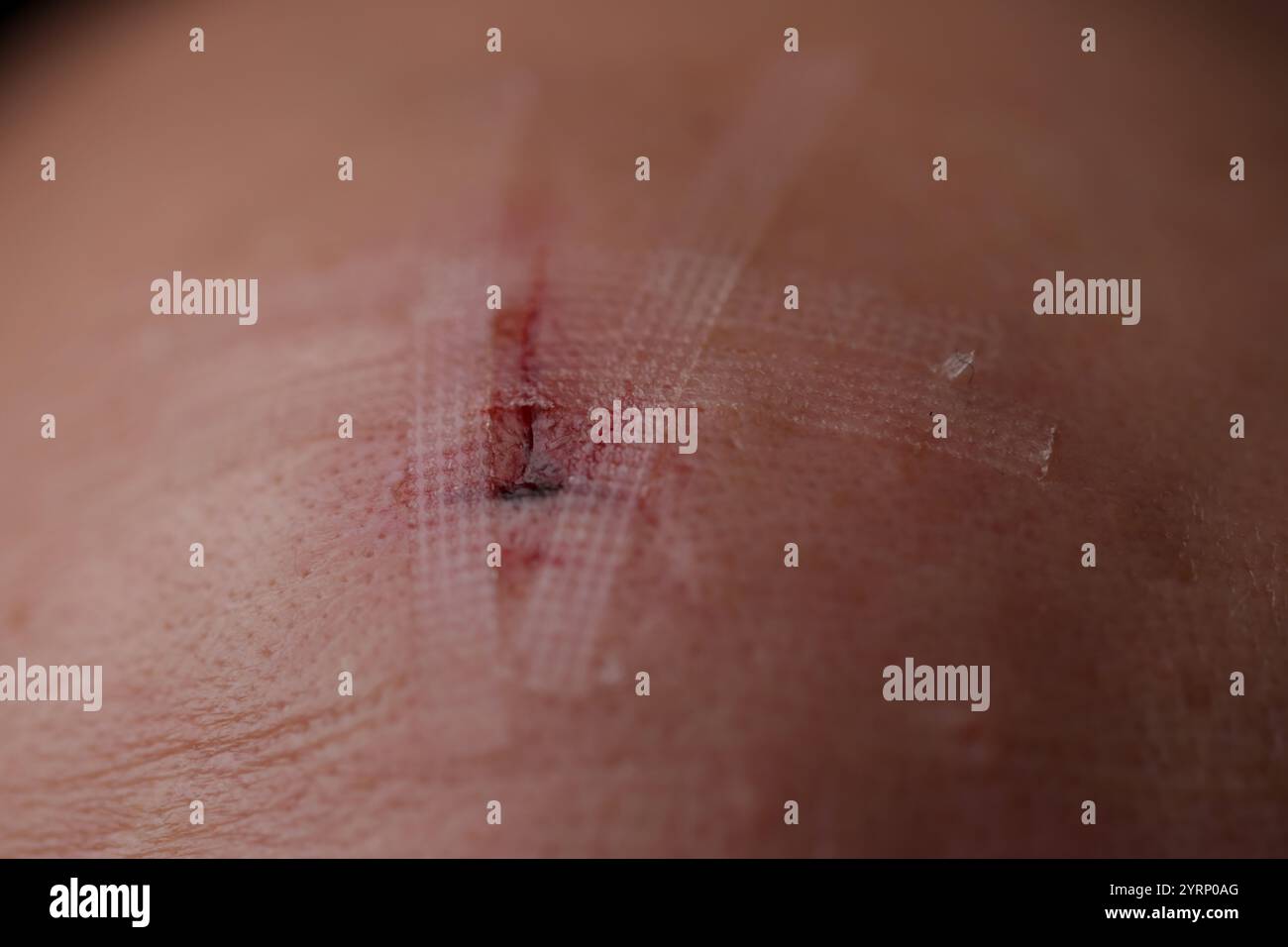 Head impact causing swelling and bleeding laceration Stock Photo - Alamy