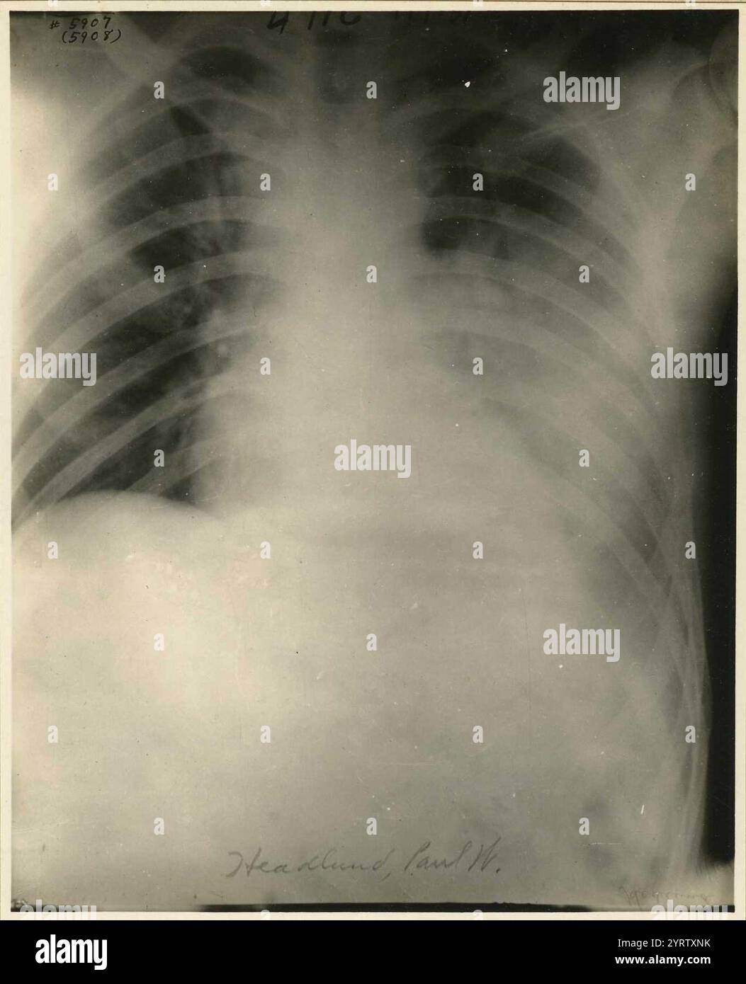 Chest X-ray of patient with influenza Stock Photo - Alamy