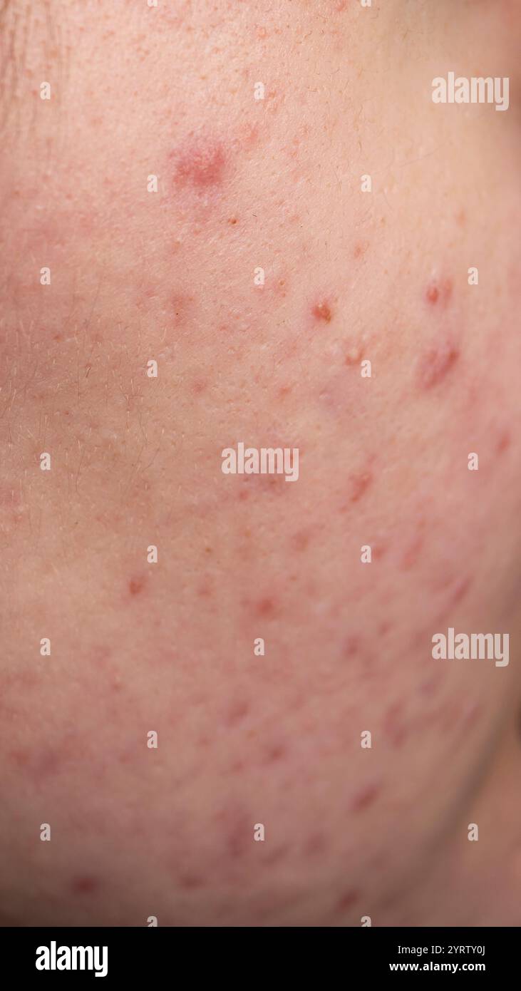 Many pimples. Bad skin. Hormonal acne, puberty. Skin acne background ...