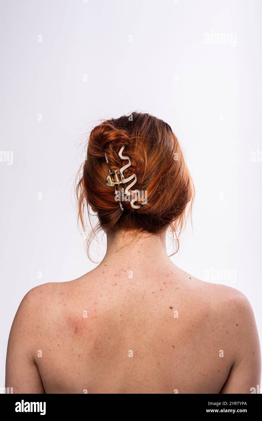 Pimple on back. Skin acne background. Pimples on back. Acne problem on ...