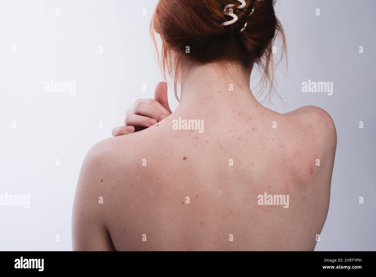 Pimple on back. Pimples on back. Skin acne background. Acne problem on ...