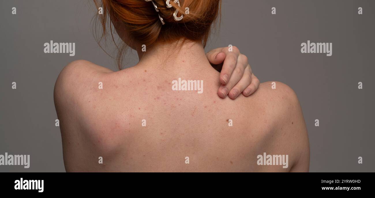 Skin acne, pimples background. Acne problem on back. Dermatology and ...