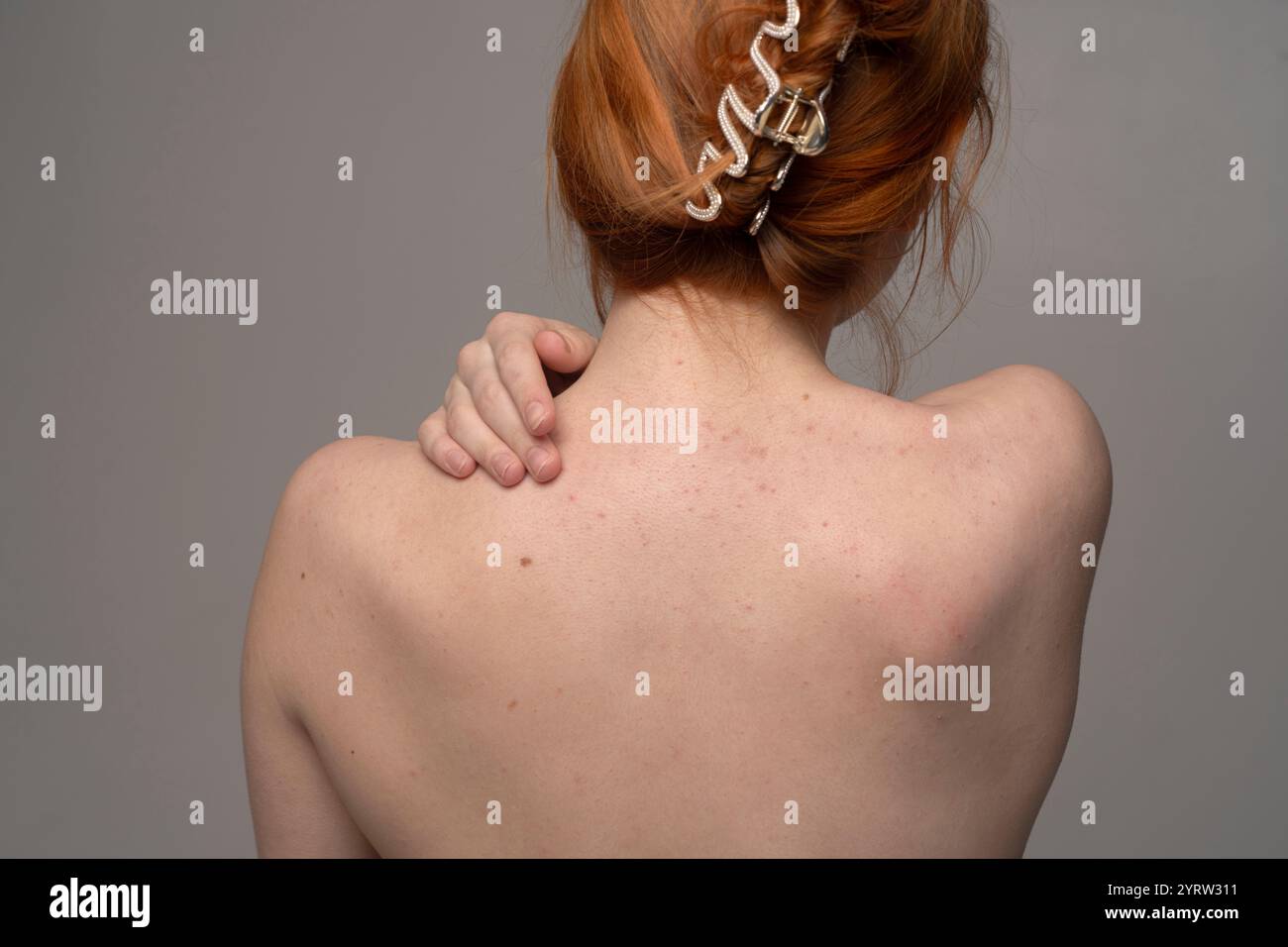 Woman scratching her back. Rash irritation. Dermatology. Itchy, itch ...