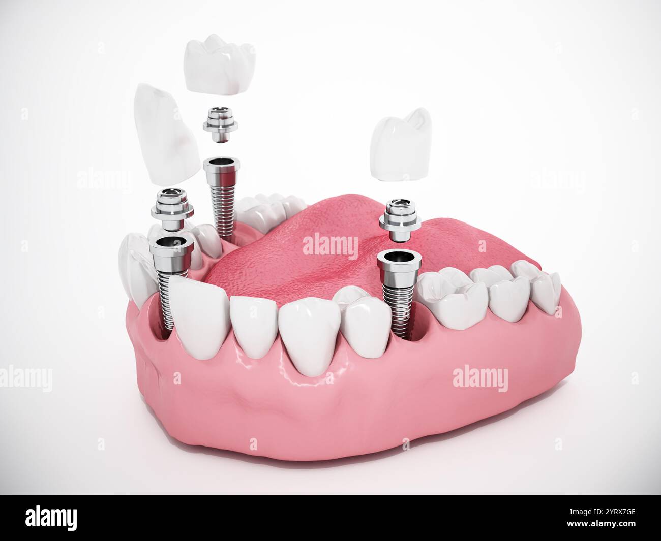 Video shows dental implants inside a half lower jaw model. 3D ...