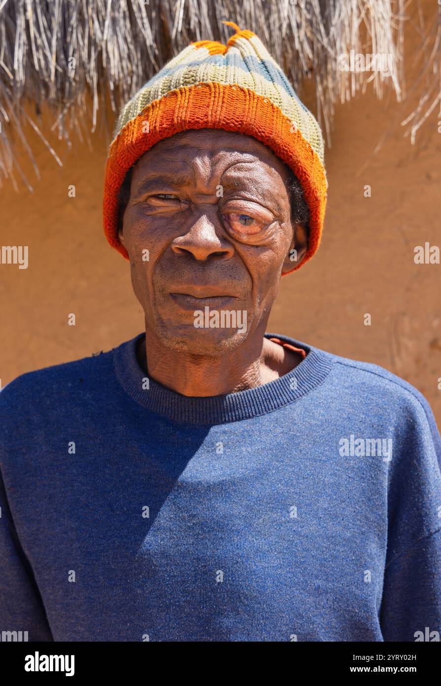 village old african man with big bulged eye , deformed face, medical ...