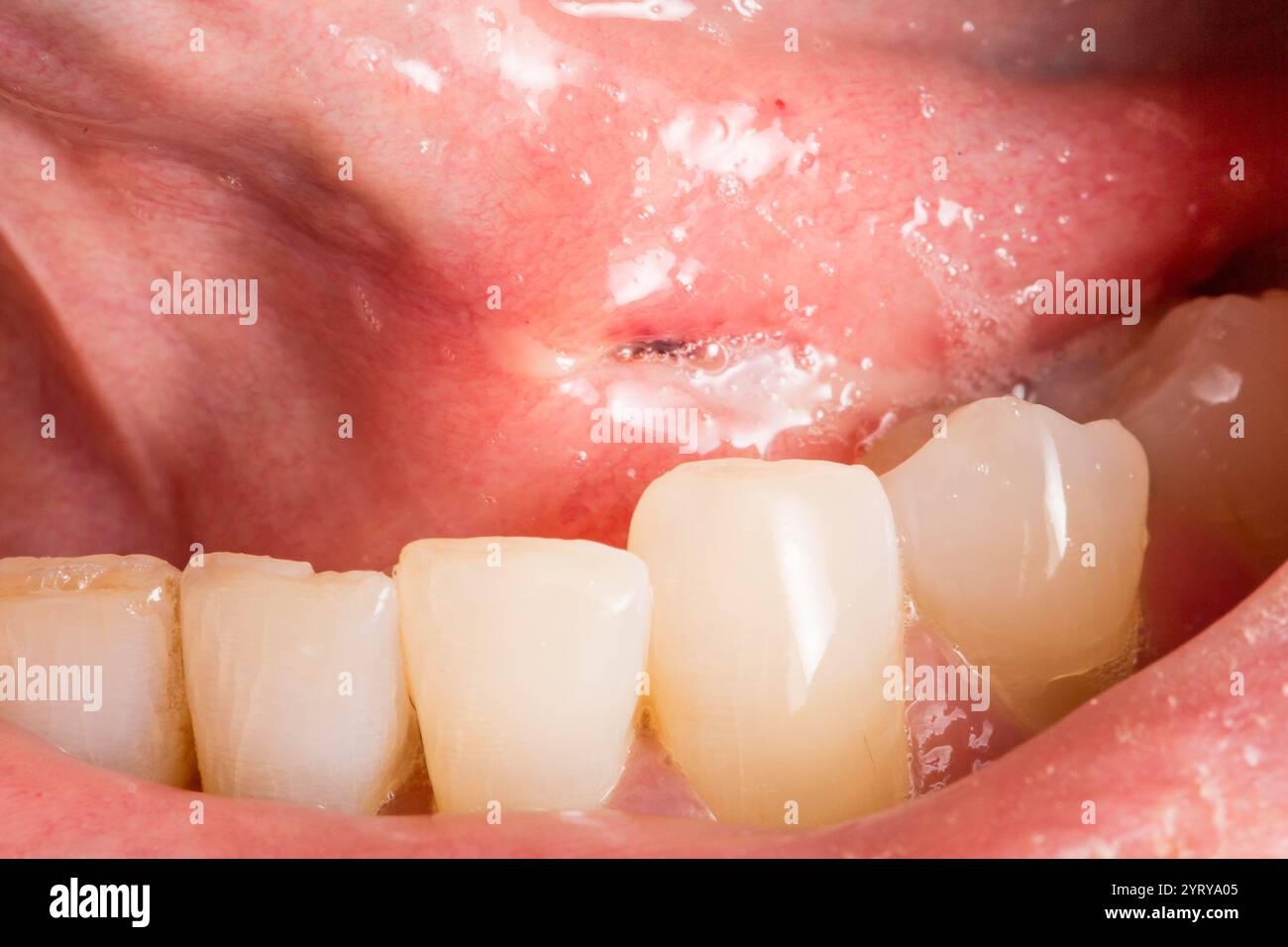 Close up of aphthous stomatitis affecting the inner cheek and gums of a ...