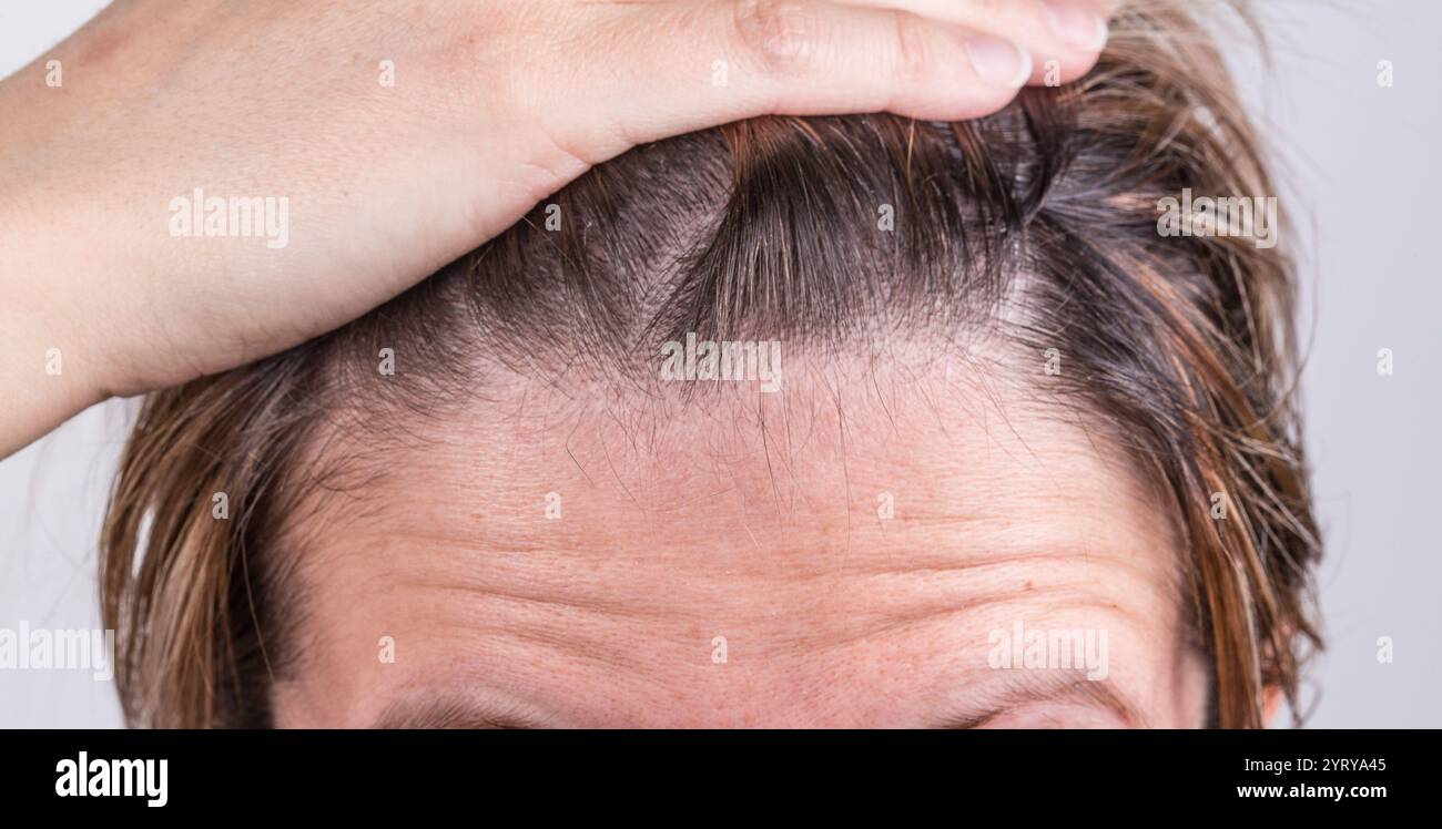 Female Pattern Baldness Receding Hairline
