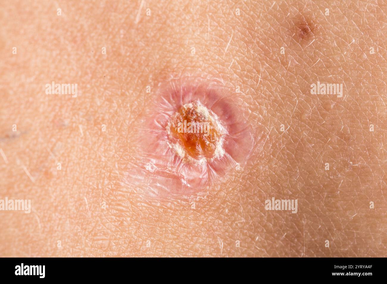 Close-up of an infected wound healing process on human skin ...