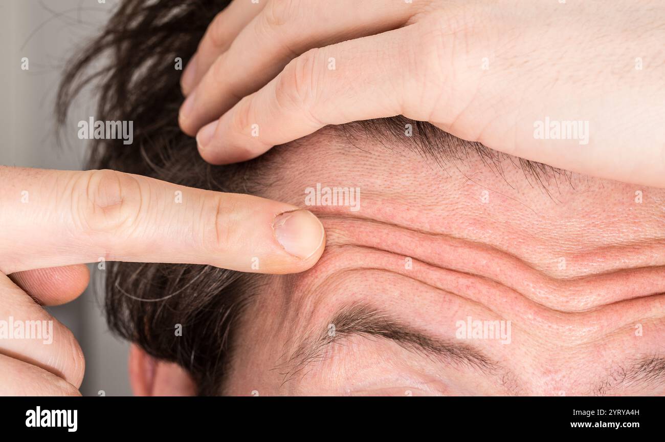Dermatologist examining forehead wrinkles of a male patient, checking ...