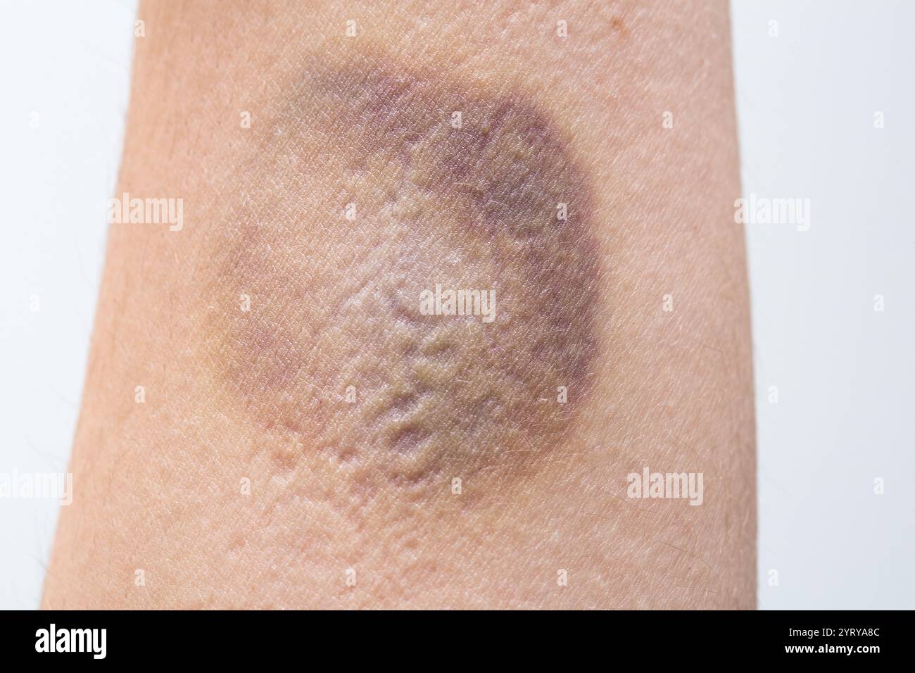 Close up of a large bruise or hematoma forming on a patient's arm after ...