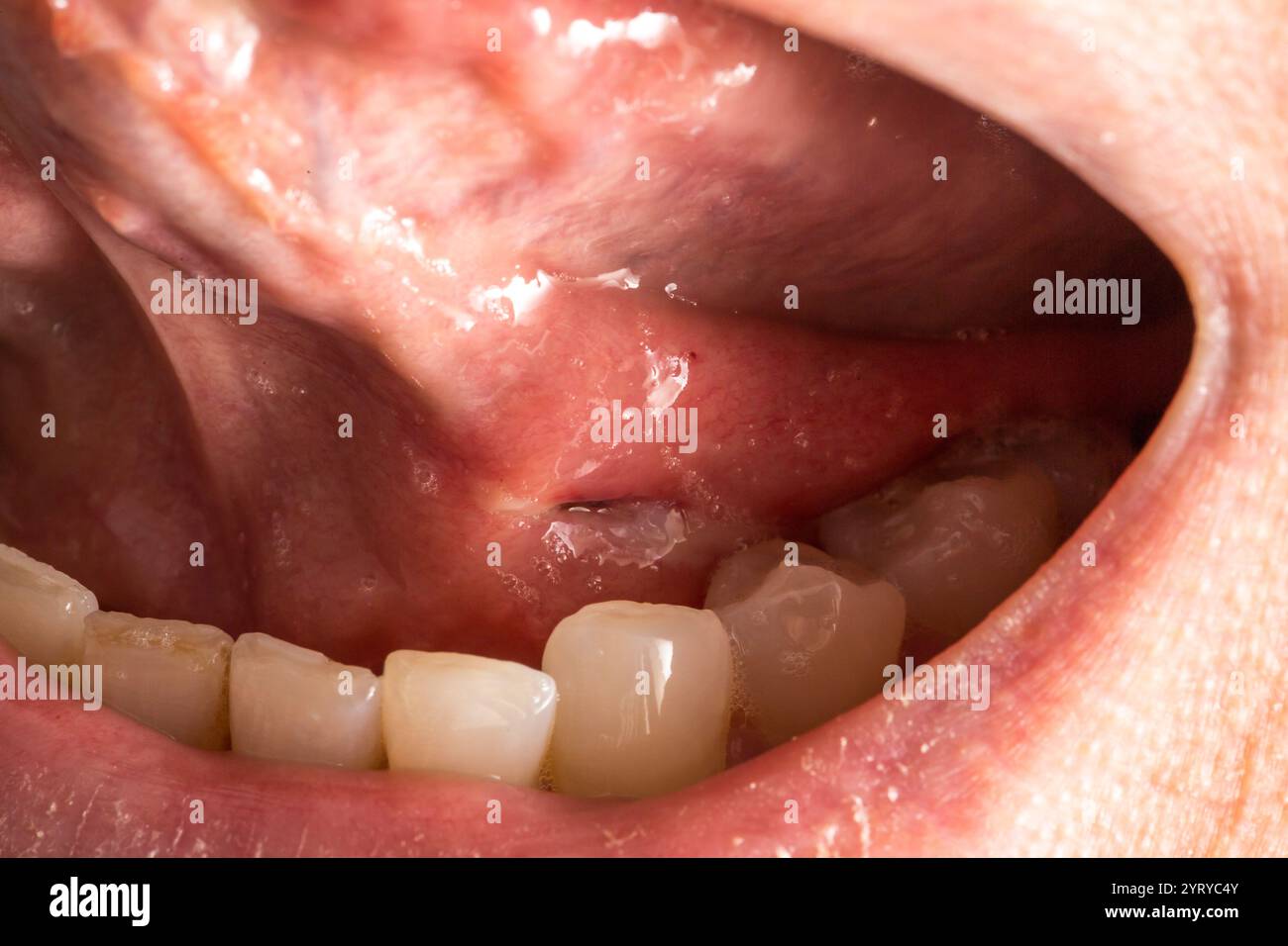 Open mouth showing stomatitis, an inflammation of the mucous membranes ...