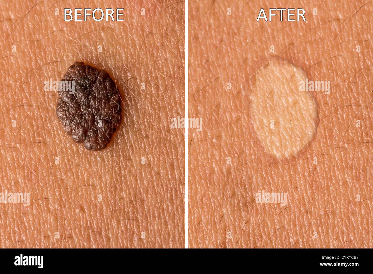 Comparison of a mole before and after laser treatment, showing ...
