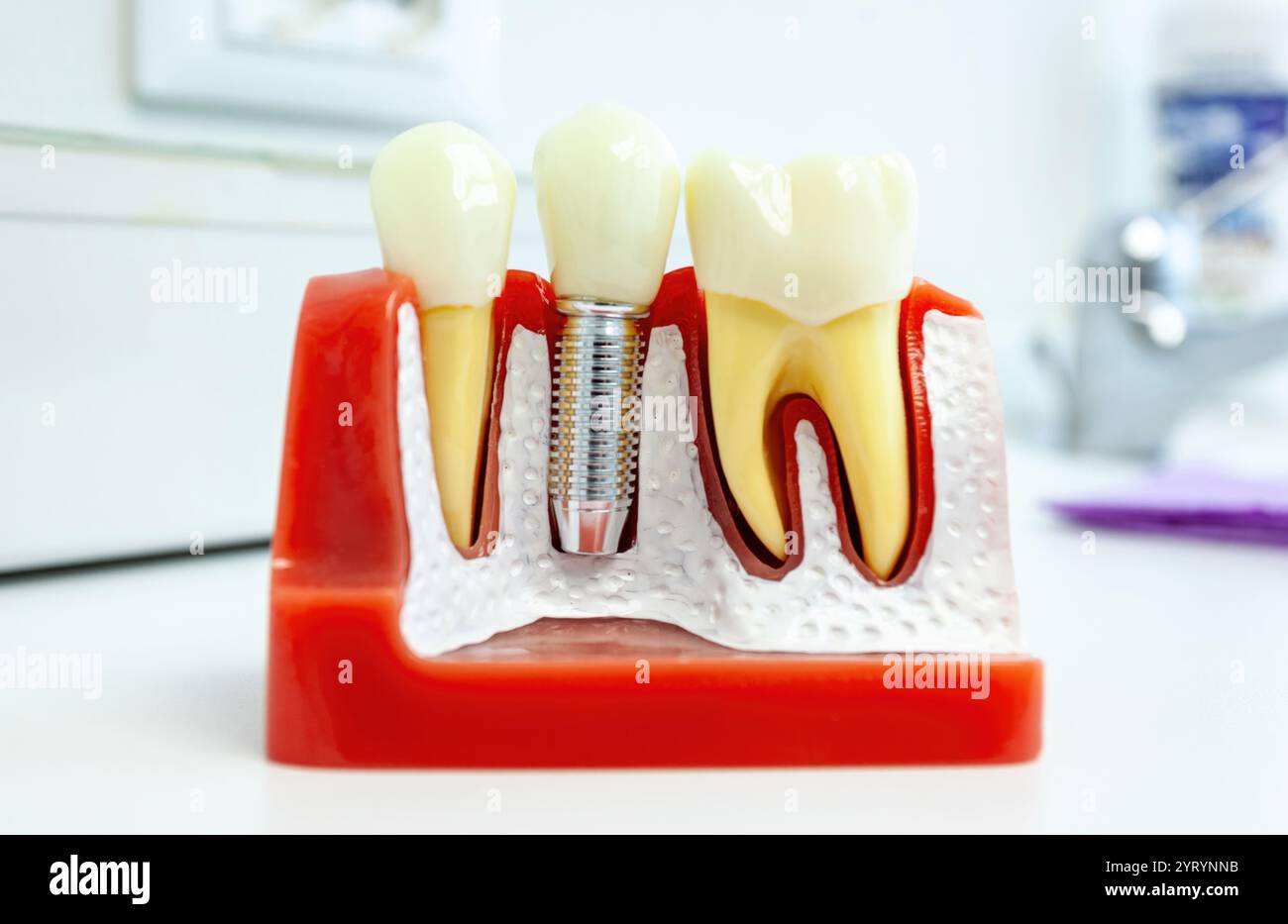 Close up of a dental implant model showing the implant screw, abutment ...