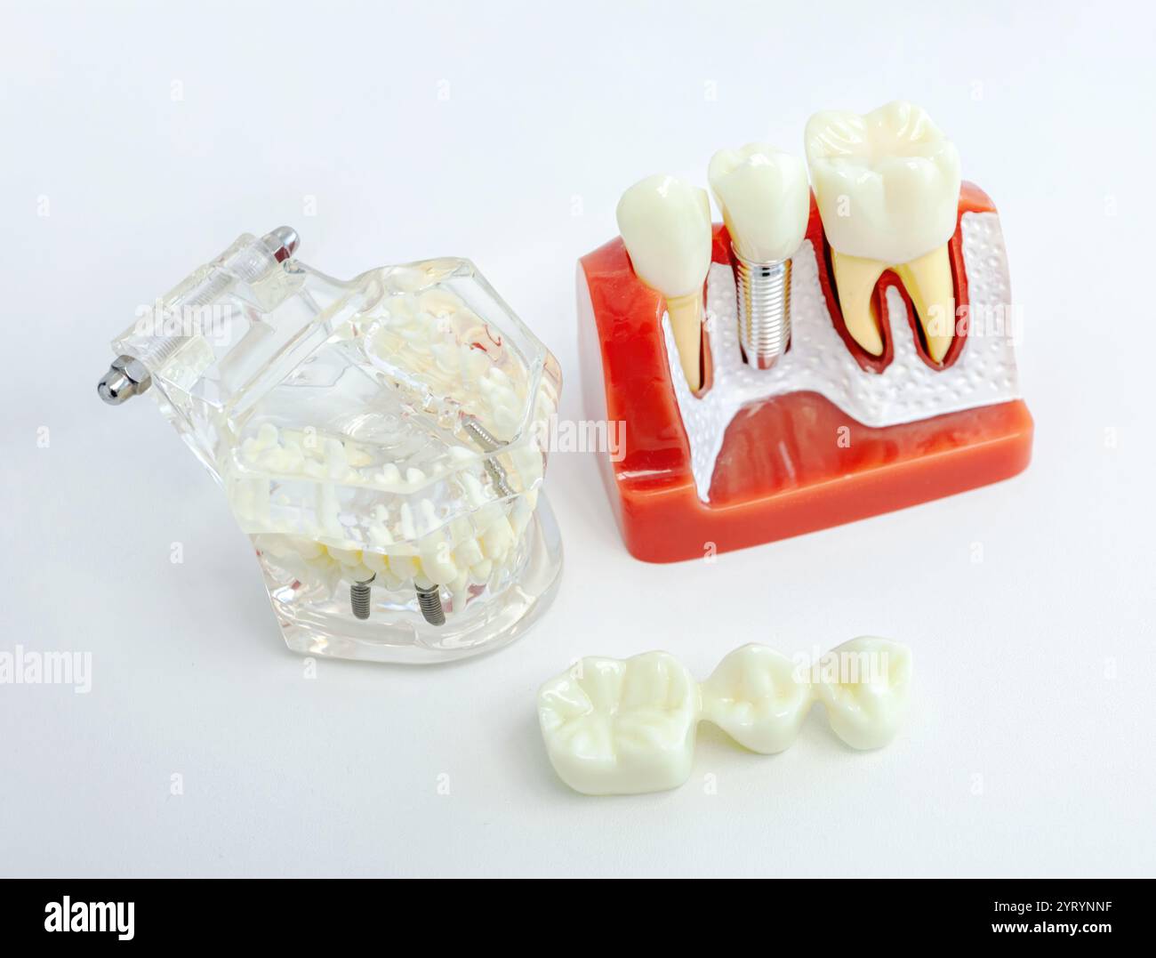 Educational dental models showing implants, dentures, and a transparent ...