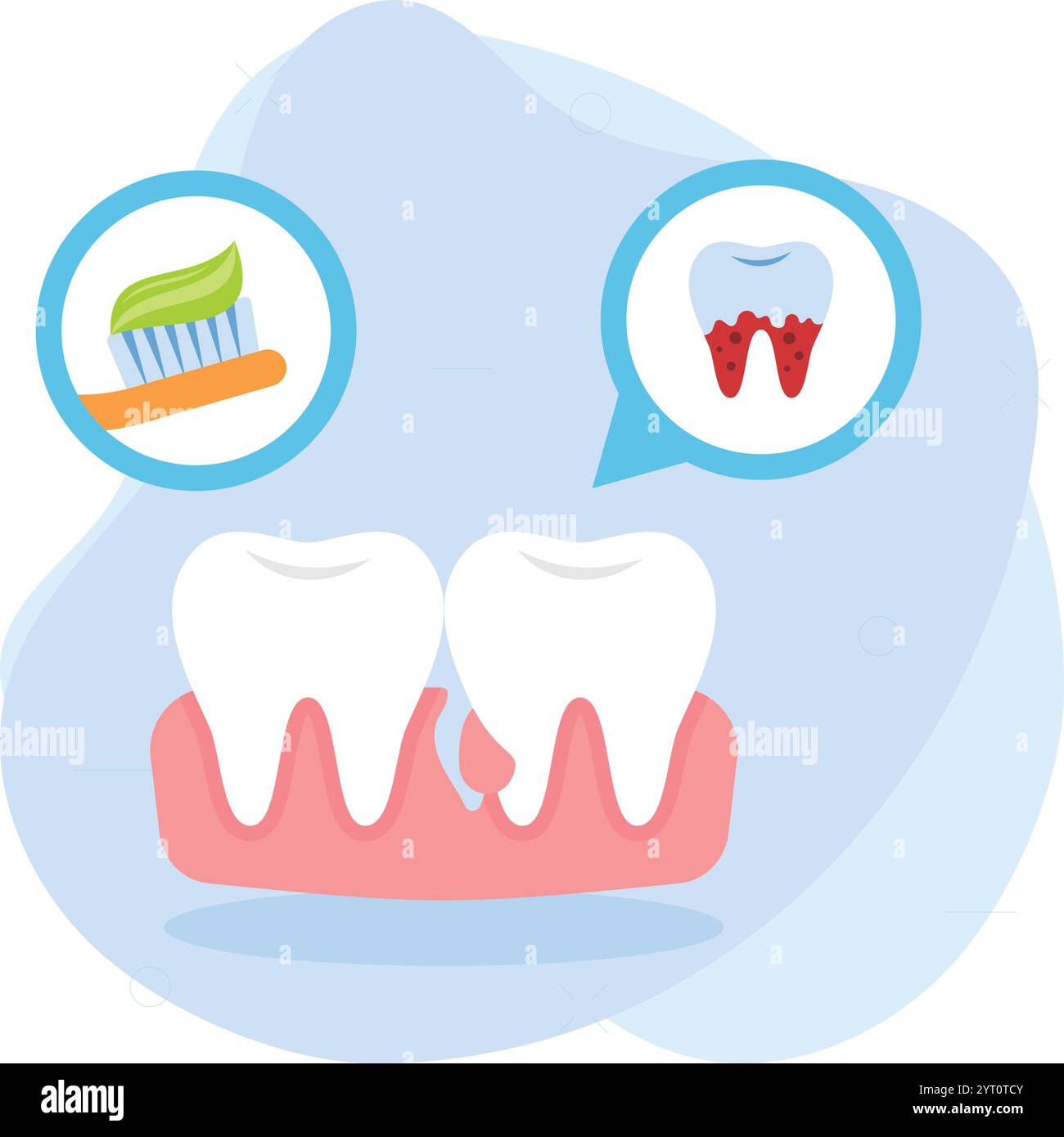 Pulpitis Fluoride treatments for Tartar and Plaque effected teeth ...