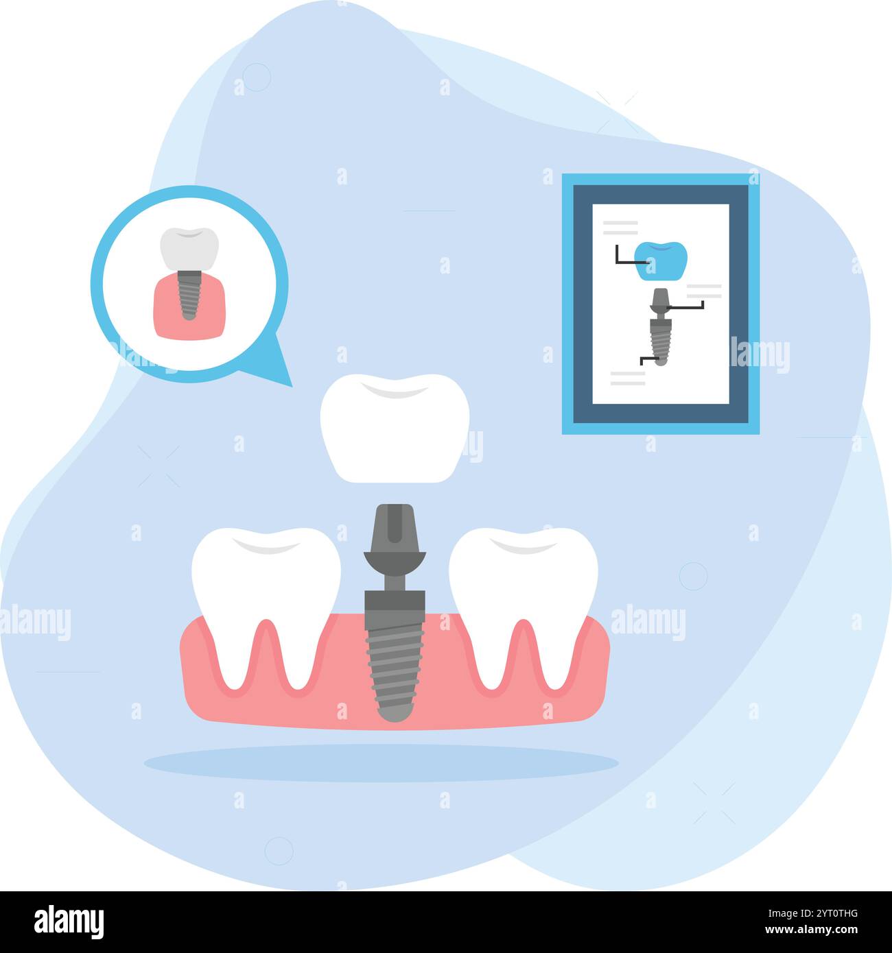 Replacing one Missing Teeth using Dental Implant Concept, permanent ... Replacing one Missing Teeth using Dental Implant Concept, permanent ...