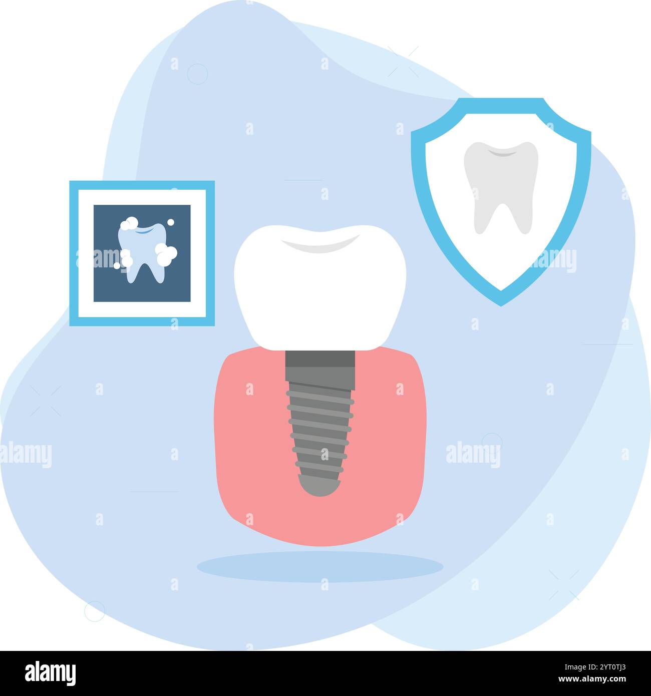 Dental Implant or Artificial prosthetic tooth root concept, Replace ...