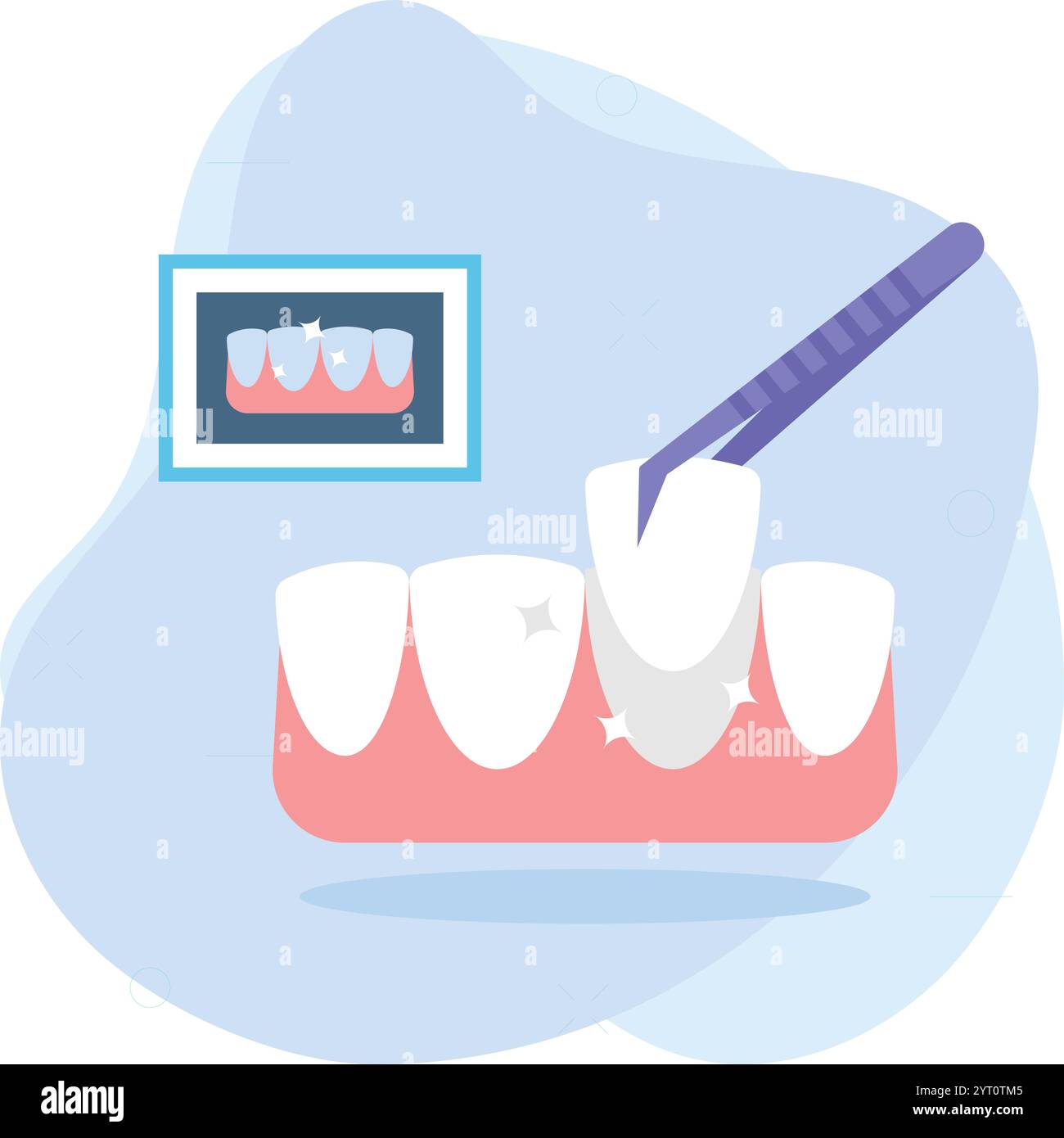 cosmetic teeth Veneers treatment concept, Tooth crown or cap bridge ...