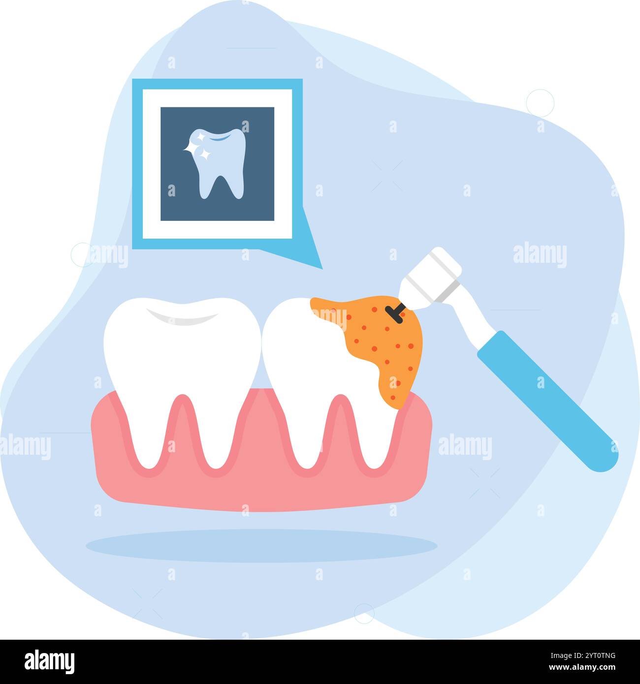 high speed dental drill airotor concept, tooth pathology Dental ...