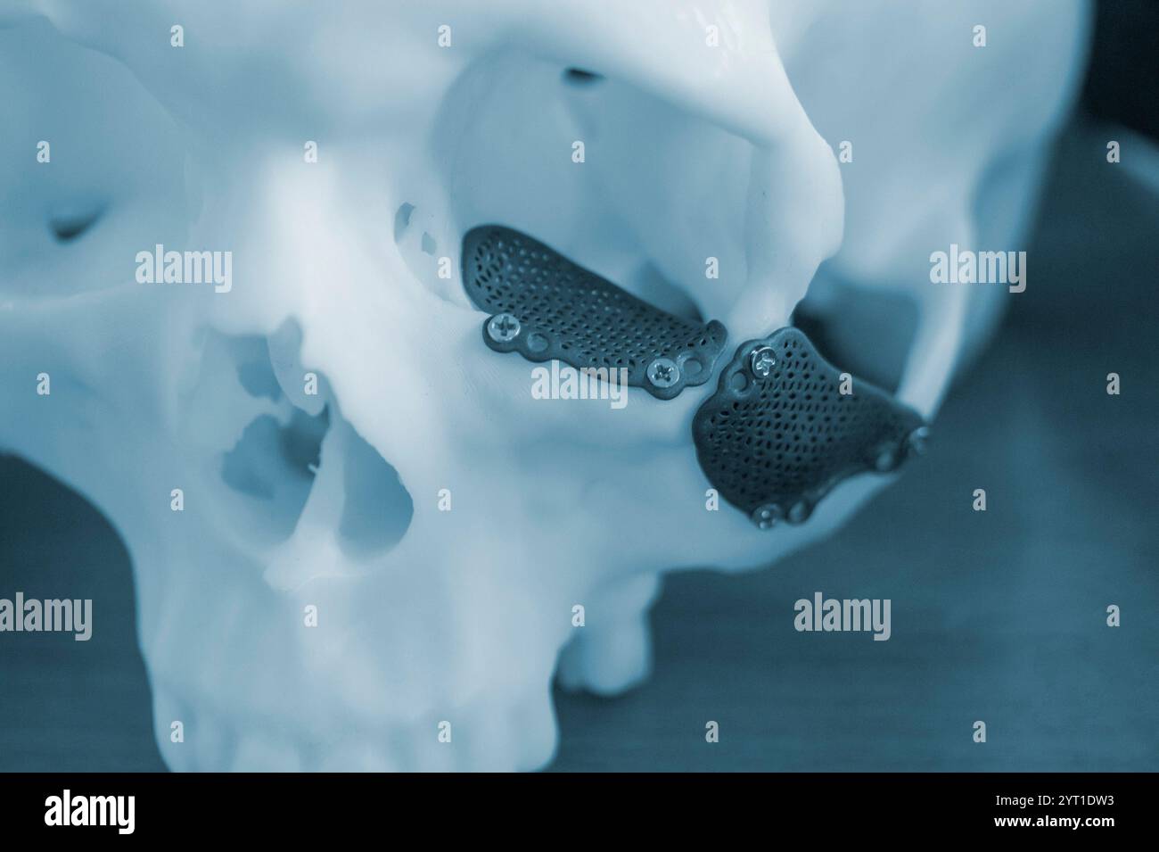 Proto-human skull from white plastic with titanium implants in form of ...