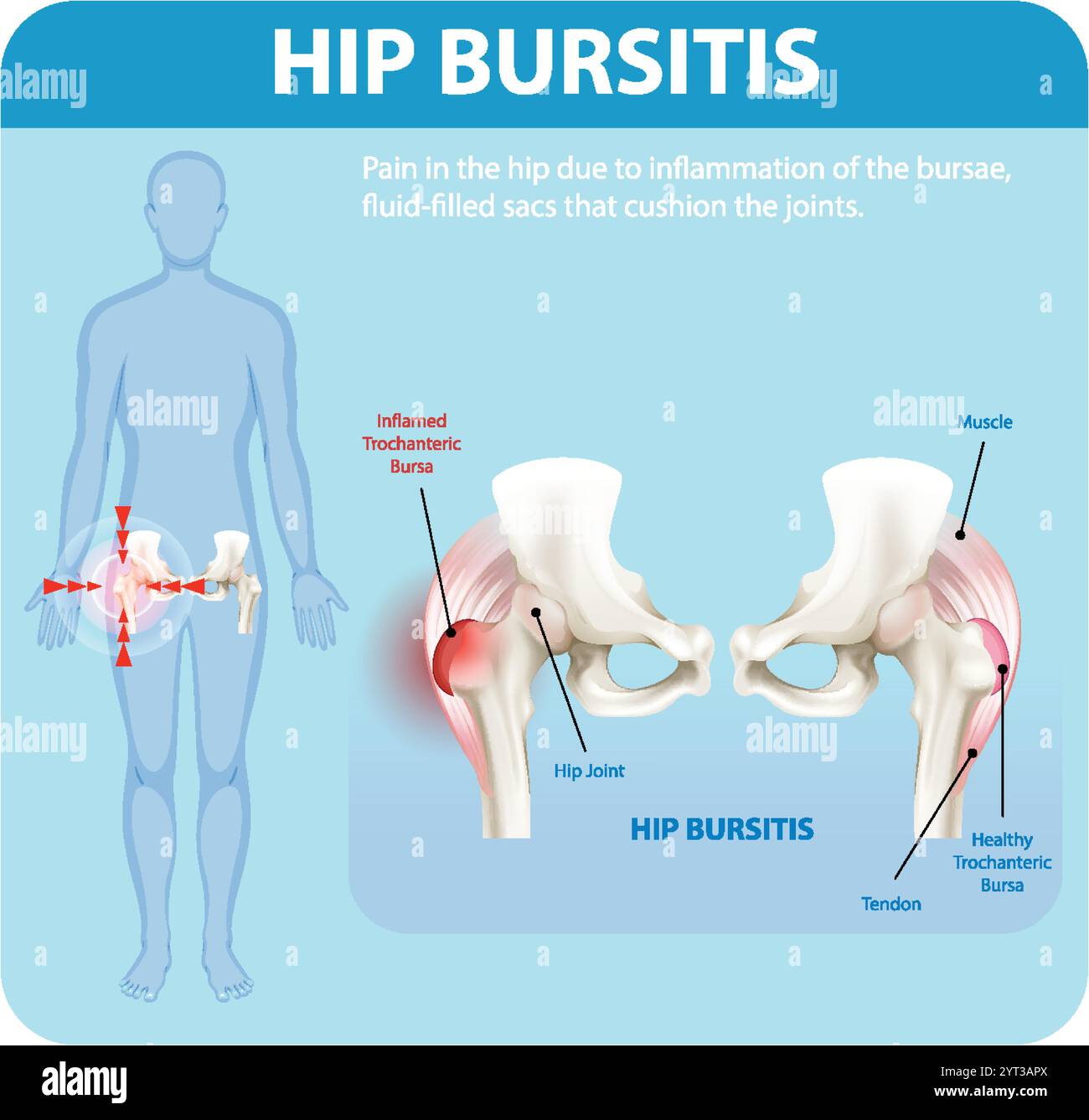 Illustration of hip bursitis and affected areas Stock Vector Image & Art - Alamy