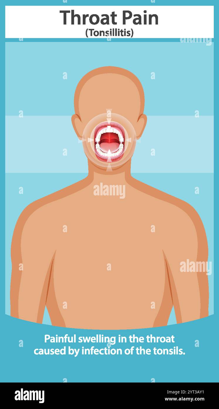 Tonsil infection hi-res stock photography and images - Alamy