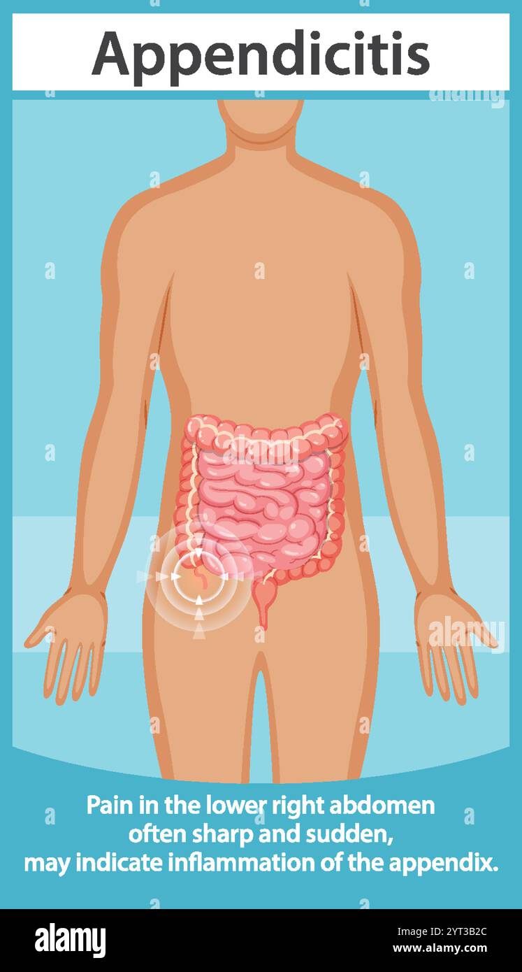 Illustration of appendicitis symptoms and abdominal pain Stock Vector Image & Art - Alamy